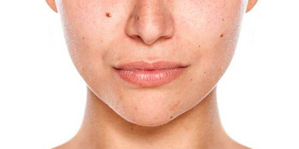 6 Methods To Combat Sun Spots on Skin in | SkinCeuticals